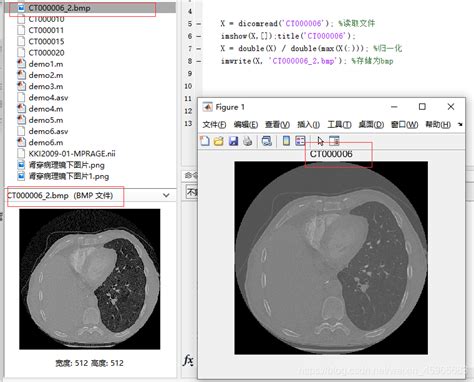 matlab—医学dicom图像处理 matlab 读取dicom图像像素灰度 csdn博客