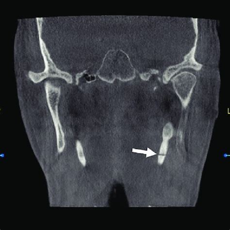 multiplanar reconstruction cone beam computed tomography images show download scientific
