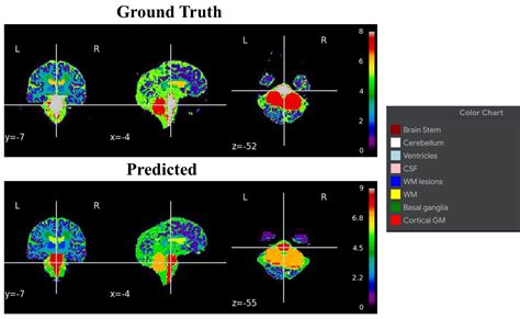 brain mri segmentation using deep learning by abhijeet khangarot kuzok medium