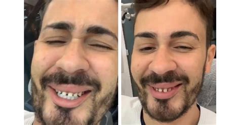 Carlinhos Maia revela como é seus dentes naturais sem a faceta Purebreak
