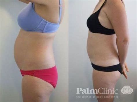 Lipoabdominoplastia Valor Antes E Depois Fotos Tudo Sobre