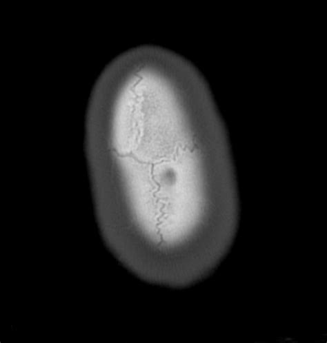 Persistent Metopic Suture Radiology Case Radshare Net