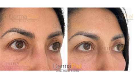 Relleno De Ojeras Dermapiel