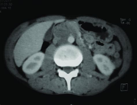 Tomodensitométrie coupe axiale abdominale montrant une masse