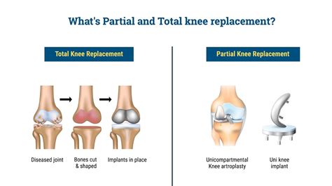 What S Partial And Total Knee Replacement Youtube
