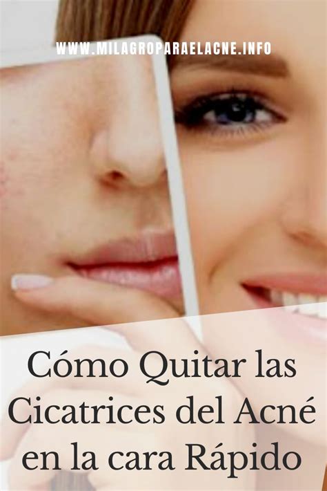 C Mo Quitar Las Cicatrices Del Acn En La Cara R Pido Como Quitar