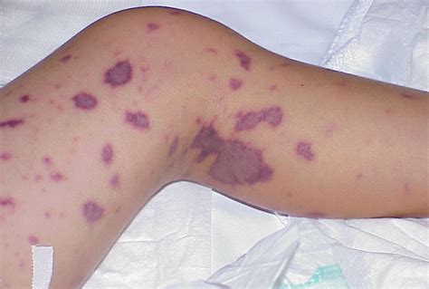 Se Reportaron M S De Casos De Meningitis Por Meningococo En Per
