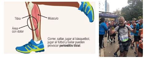 Periostitis tibial Dr Revenga Giertych Traumatólogo en Cádiz