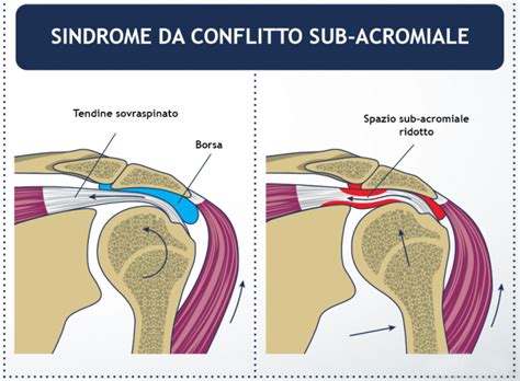 La Cuffia Dei Rotatori