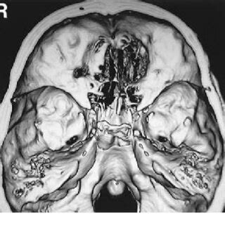 Three Dimensional Computed Tomography Scan Of The Skull Base