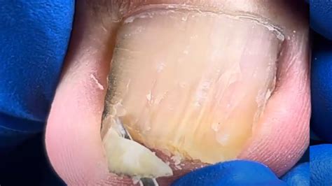 Pedicure Tutorial Huge Ingrown Nail Trimming Full Process Xue Yidao