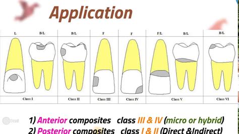 Dental Composite Part 2 4 YouTube