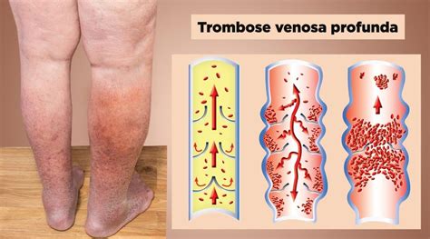 Embolia pulmonar o que é causas sintomas e tratamento 2022