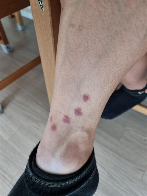 This Trail Of Bites A Mosquito Left On My Husband S Leg R