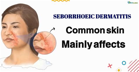 Seborrheic Dermatitis Symptoms And Causes Dr Vanitha