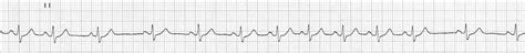 Abnormal Sinus Rhythm On Ekg Sale Jkuat Ac Ke