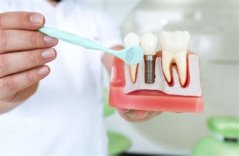 Seguros Dentales Para Implantes 3 Datos Importantes