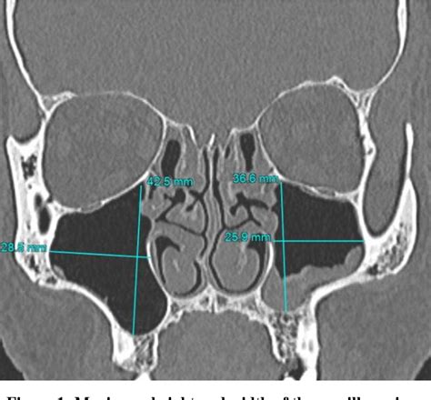 Pdf Validity Of Computed Tomography Maxillary Sinuses Dimensions Measuring In Sex