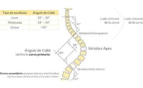 El Ángulo de Cobb Análisis Completo Recursos de Fisioterapia