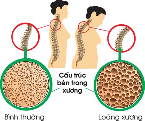 Benh Loang Xuong La Gi Ch M S C S C Kho Ng I Cao Tu I