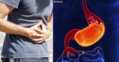 Acidez estomacal qué es y cómo tratarla Va a gustarme