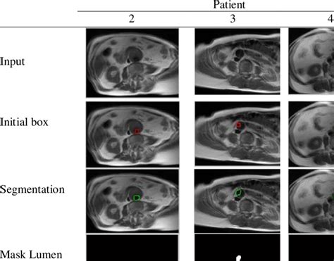 the result of automatic segmentation on lumen area on patient 2 3 and 4 download scientific