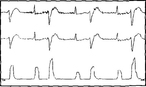 [pdf] a robust open source algorithm to detect onset and duration of qrs complexes semantic