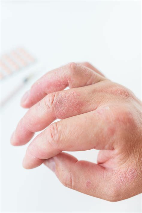 10 causas mais comuns de inchaço nas mãos Clínica Ortotrauma Samaritano