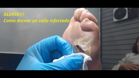 Como Drenar Un Callo Super Infectado En Pie Diabetico YouTube