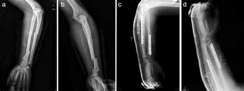 Ab Preoperative Radiographs Show A Classic Monteggia And Galeazzi