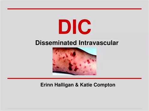 PPT DIC Disseminated Intravascular Coagulation PowerPoint