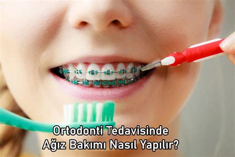 Ortodonti Tedavisinde Ağız Bakımı Nasıl Yapılır Dr Dt Bircan
