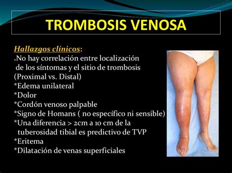 Trombosis Venosa Profunda Signos Trombosis Venosa Profunda Images And