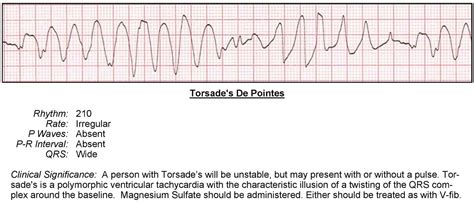 Polymorphic Ventricular Tachycardia Ecg