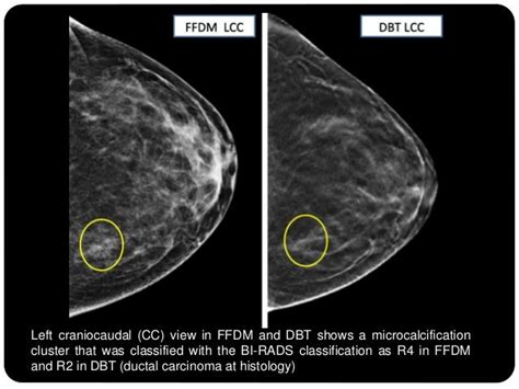 digital breast tomosynthesis microcalcifications