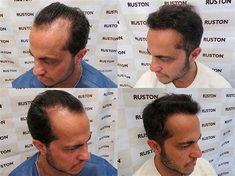 Thammy Miranda Mostra Antes E Depois De Transplante Capilar Cabeludo