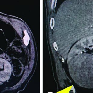 Results Of Preoperative Abdominal Contrast Enhanced CT A B