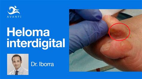 Heloma Interdigital u Ojo de Gallo Podología Dr Iborra YouTube