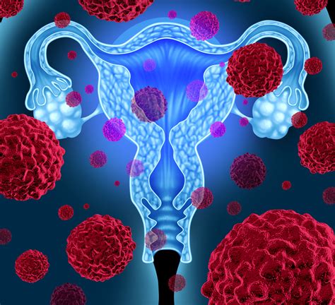 Olaparib se confirma como terapia de mantenimiento estándar en ovario