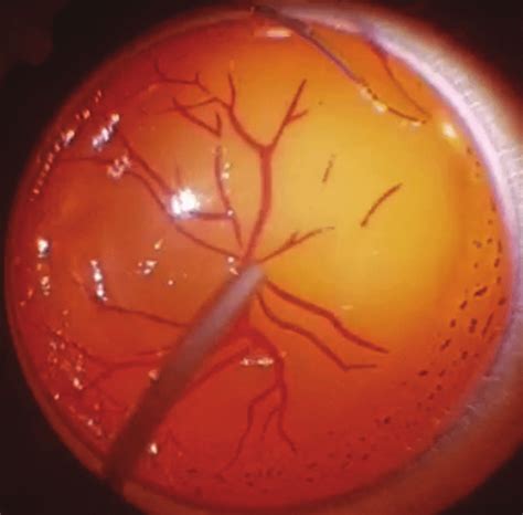 Image Demonstrating Laser Photocoagulation Practice On Petg Film