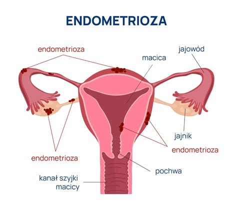 Endometrioza Wczesna Diagnostyka Testem Endomkit