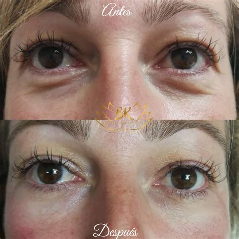Relleno de Ojeras con Ácido Hialurónico Clínica BK