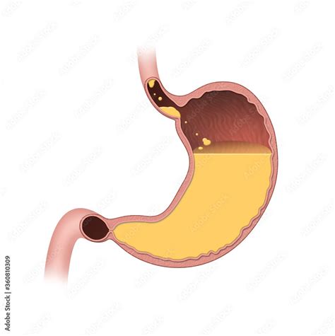 The Stomach Is A Muscular Hollow Organ In The Digestive System The