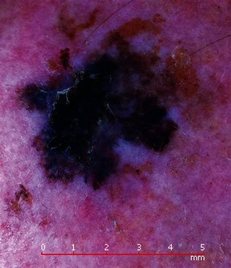 Albums Pictures Photos Of Melanoma On Scalp Latest