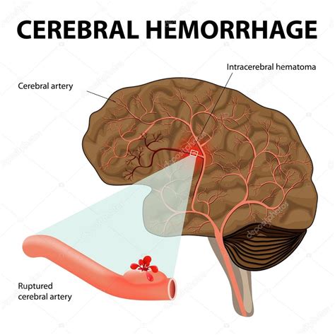 Sntomas Causas Y Tratamiento Contra La Hemorragia Cerebral