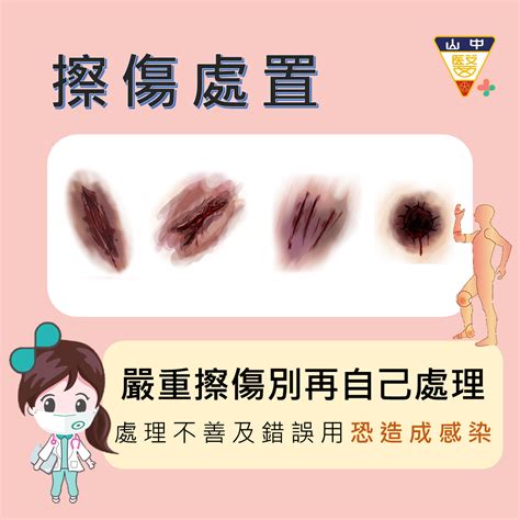 擦傷處置 中山醫職業衛生護理中心