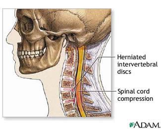 Cervical Herniated Disk Uf Health