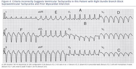 Ventricular Tachycardia Vs Supraventricular Tachycardia