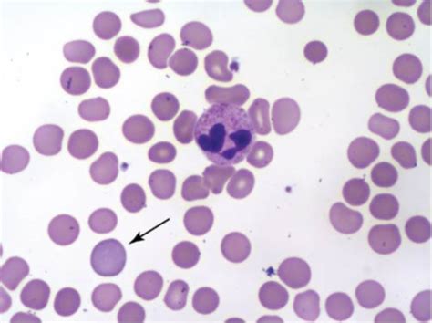 Exam Hematology Flashcards Quizlet