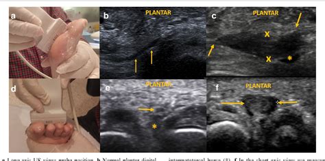 Short Term Comparison Between Blind And Ultrasound Guided Injection In
